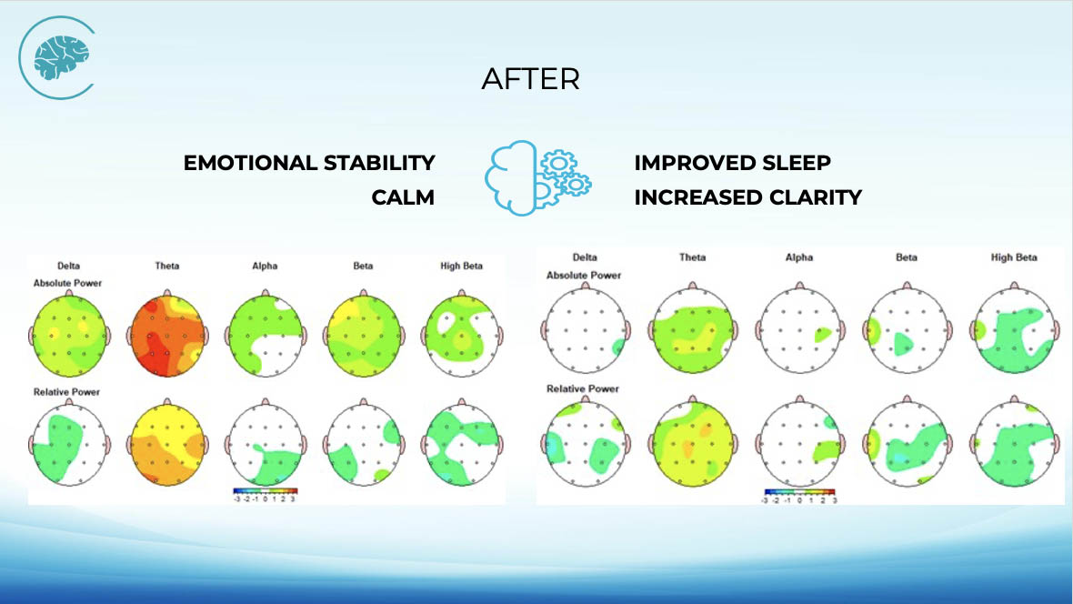 qEEG Brain Mapping | Braincode